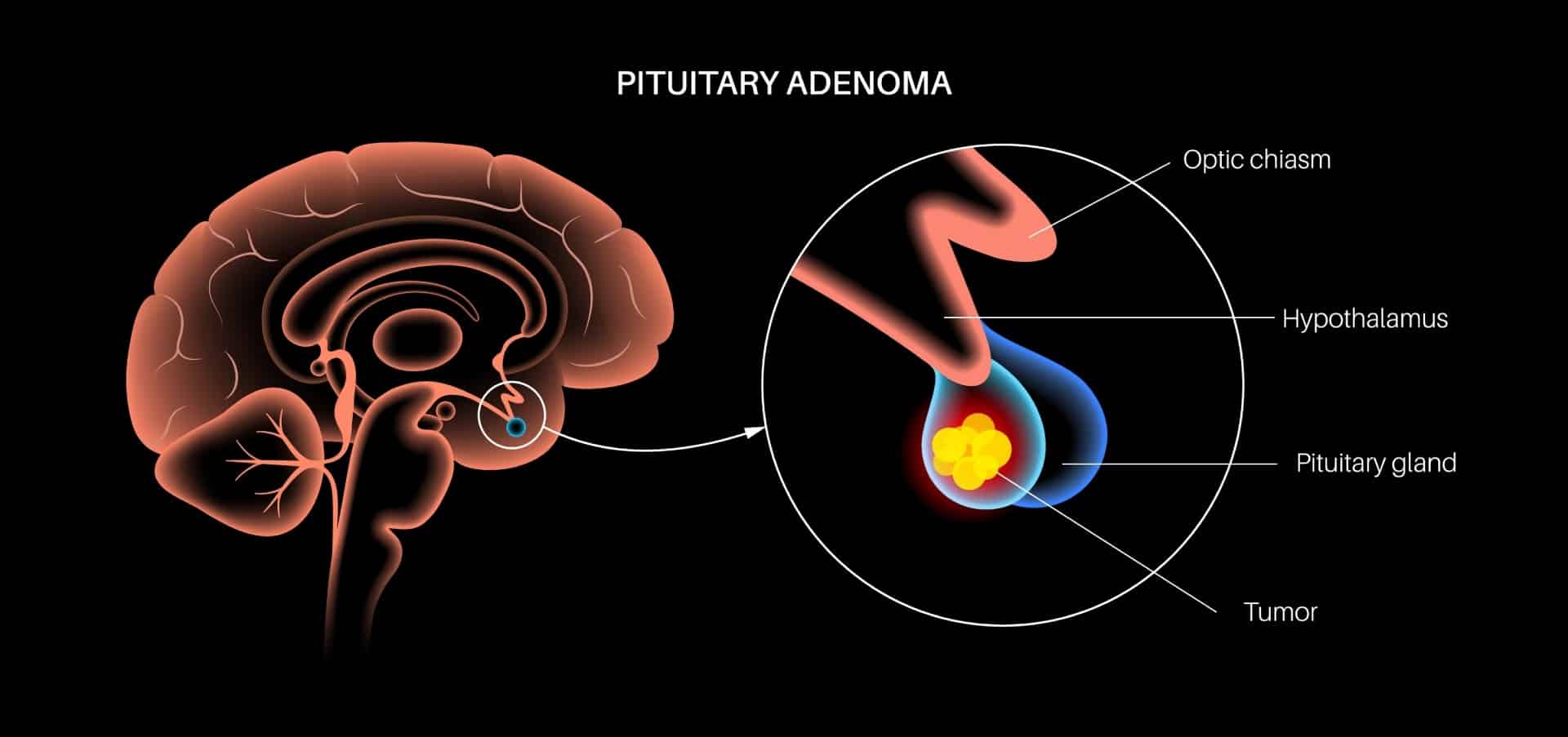 Pituitary Adenoma (Tumour) and Prolactinoma